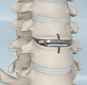 Neck Surgery West Valley City | Lumbar Fusion | Robotic Spine Surgery ...