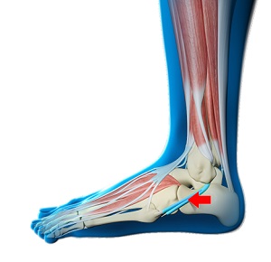 Ankle Tendonitis | Dr. Collin Messerly, Foot & Ankle Surgeon, Ashburn ...