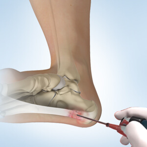 Minimally Invasive Bunion Surgery Reston VA | Heel Surgery Ashburn VA