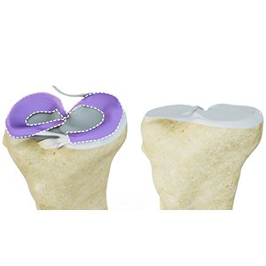 Prior Meniscectomy Portland | Meniscus Tears Bangor | Partial ...