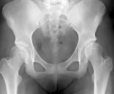 Periacetabular Osteotomy Randwick NSW | Acetabular Dysplasia Sydney NSW