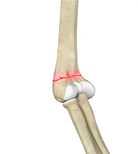 Distal Humerus Fractures of the Elbow Washington State | Elbow Pain