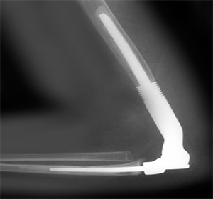 Distal Humerus Resection | Distal Humerus Reconstruction Washington State
