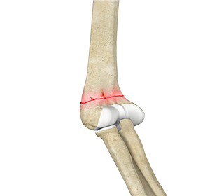 Elbow Fractures | Olecranon Fractures Idaho, Washington State