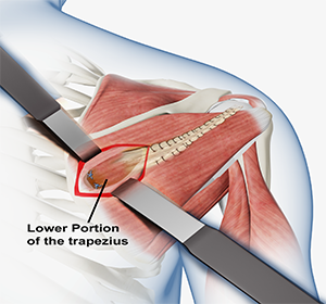 Lower Trapezius Tendon Transfer | Rotator Cuff Tear Washington State