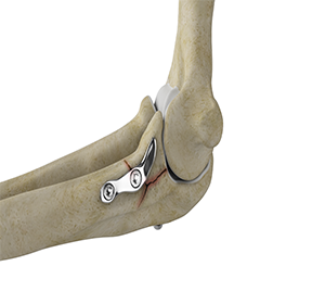 ORIF of the Coronoid Fractures | Elbow Dislocation Washington State