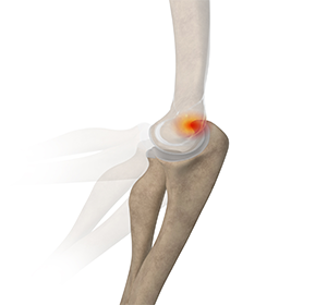 Posterior Impingement of the Elbow Idaho | Elbow Specialist