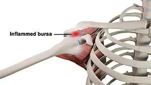 Shoulder Bursitis | Subacromial Bursitis | Shoulder Pain Washington State