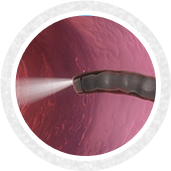 Colon Cancer Screening Cypress TX | Endoscopy Spring, Spring, Mission Bend