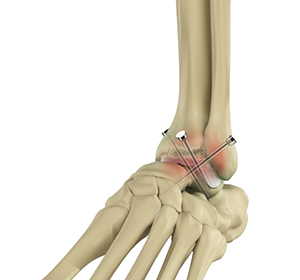 Ankle Fusion Salt Lake City, UT | Ankle Fracture South Jordan ...