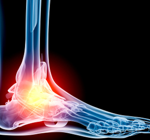 Foot Problems Salt Lake City, UT | Athlete’s Foot South Jordan, UT ...