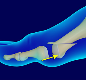 Metatarsal Surgery Salt Lake City, UT | Metatarsal Fractures South ...