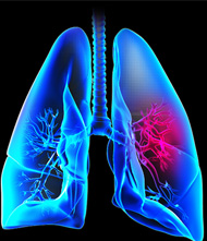 Bronchiectasis London | Troublesome Cough | Lung Cancer London