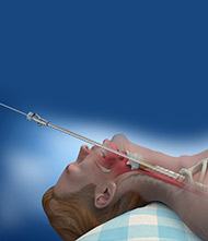 Bronchiectasis London | Troublesome Cough | Lung Cancer London