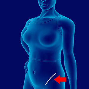 Bikini Incision Anterior Hip Replacement Fresno CA | Hip Arthroplasty ...