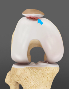 Knee Arthritis Fresno CA | Knee Pain Fresno | Knee Sprain San Joaquin ...