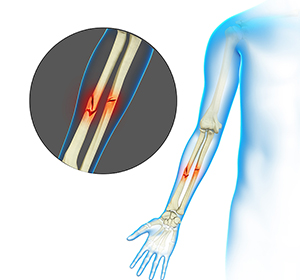 Adult Forearm Fractures South Jordan | Forearm Fractures Treatment Salt ...