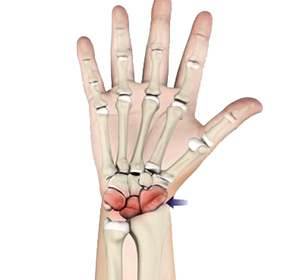 Hand Arthritis South Jordan,Utah | Wrist Arthritis Salt Lake City ...