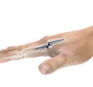 Artificial Finger Joint Replacement South Jordan | Arthritis of the ...