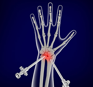 Distal Radioulnar Joint Arthroscopy Farmington | Wrist Joint Pain Salt ...
