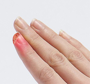 Fingertip Injuries Farmington UT | Mallet Finger Salt Lake City, South ...