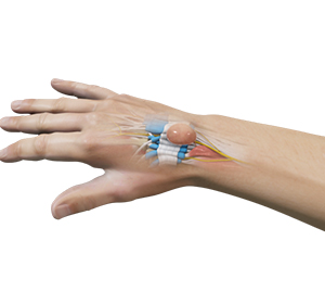 Ganglion Cyst Treatment South Jordan | Wrist Pain Treatment Salt Lake ...