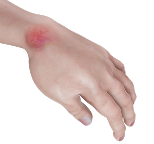 Hand Infections South Jordan | Tendon Sheath Infection | Hand Surgery ...