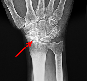 Scapholunate Advanced Collapse (SLAC) Wrist South Jordan | Wrist ...