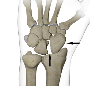 Scapholunate Dissociation Salt Lake City | Wrist Pain South Jordan ...