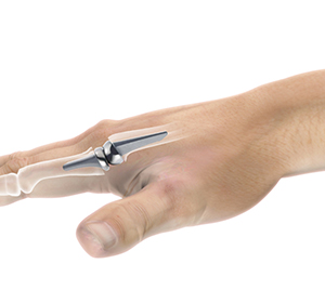 Surgery for Thumb Arthritis Salt Lake City | Surgery for Digit ...