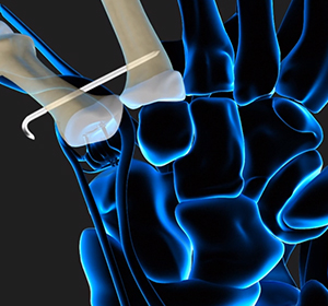 Thumb Arthroplasty with Arthrex FiberLock Suture Anchors Salt Lake City ...