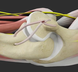 UCL Reconstruction Salt Lake City | Tommy John Surgery | UCL Injury ...