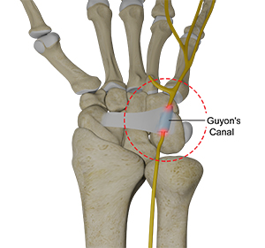 Ulnar Nerve Compression in Guyon's Canal Farmington | Hand Surgery Salt Lake City