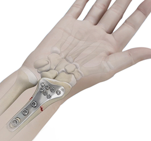 Wrist Open Reduction and Internal Fixation South Jordan | Wrist ...