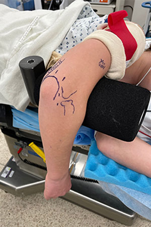 Elbow Arthroscopy in the Throwing Athlete Oklahoma County | Elbow ...