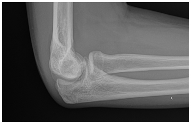 Capitellar OCD Oklahoma County | Elbow Arthroscopy Oklahoma County