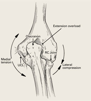 Olecranon Stress Fracture Oklahoma County | Elbow Fractures Oklahoma County