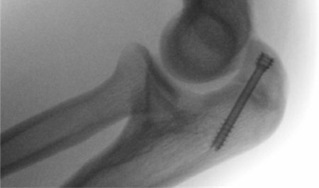 Olecranon Stress Fracture Oklahoma County | Elbow Fractures Oklahoma County