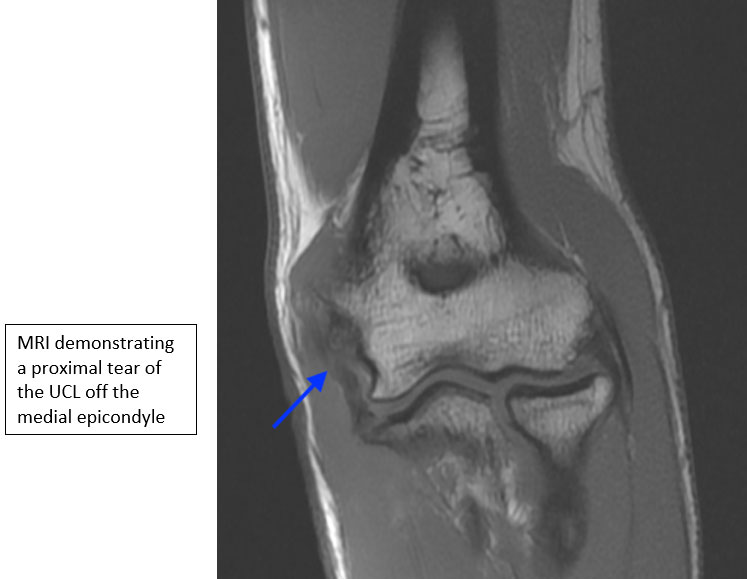 Ulnar Collateral Ligament Injury Oklahoma County | Tommy John Surgery ...