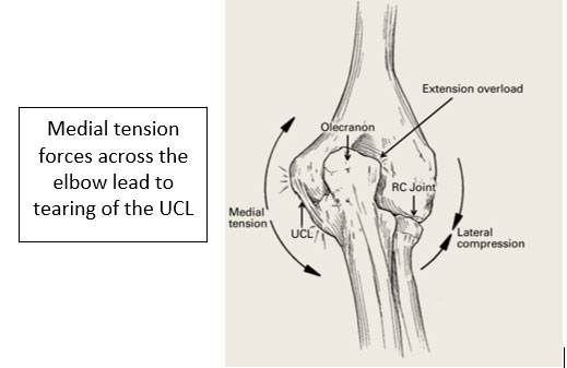 Ulnar Collateral Ligament Injury Oklahoma County | Tommy John Surgery ...