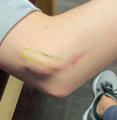 Ulnar Nerve Subluxation Oklahoma County | Cervical Radiculopathy ...