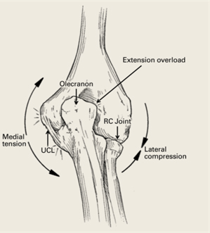 Valgus Extension Overload Oklahoma County | Elbow Pain Oklahoma County