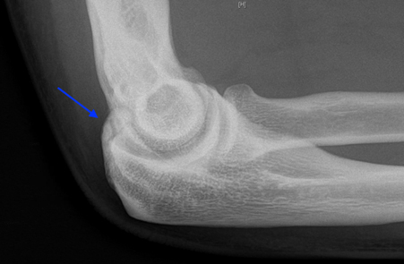 Valgus Extension Overload Oklahoma County | Elbow Pain Oklahoma County