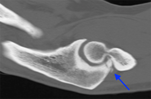 Valgus Extension Overload Oklahoma County | Elbow Pain Oklahoma County