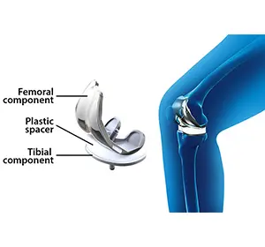 Total Knee Replacement Boston, Chestnut Hill, MA | Knee Arthritis ...