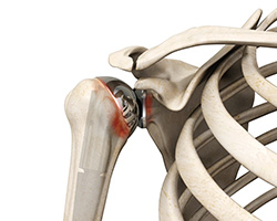 Revision Shoulder Replacement Phoenix, AZ | Total Shoulder Replacement ...