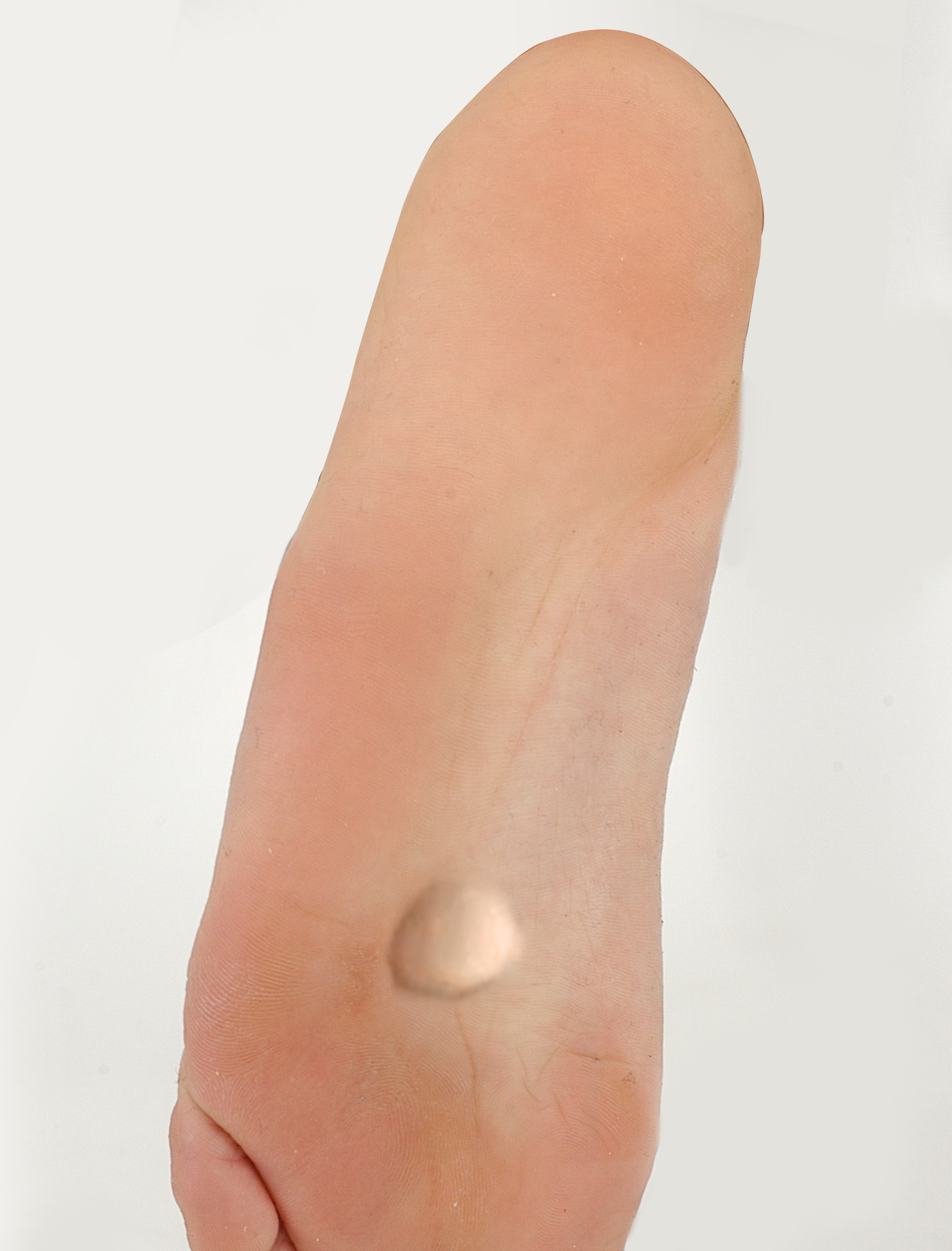 Plantar Fibromas Bristol, TN | Foot Surgery | Diabetic Foot Ulcer ...