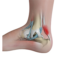 Ankle Tendonitis Treatment New York NY | Ankle Pain Staten Island ...