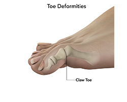 Toe Deformity Correction New York NY | Tendon Lengthening Staten Island ...