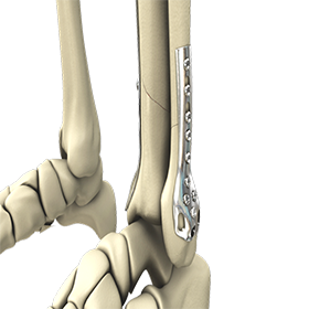 Leg Fracture Portland, OR | Foot Fractures Milwaukie | Ankle Fracture ...